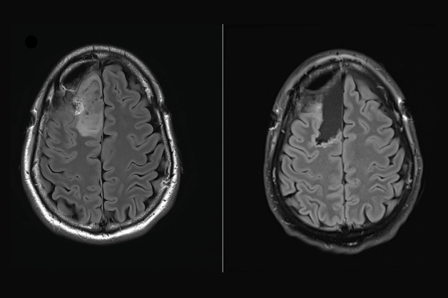 World-first clinical trial brings new hope for brain cancer patients - The Brain Cancer Centre